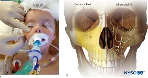 Infraorbital Nerve Block And Sensory Area Of The Infraorbital Nerve NYSORA
