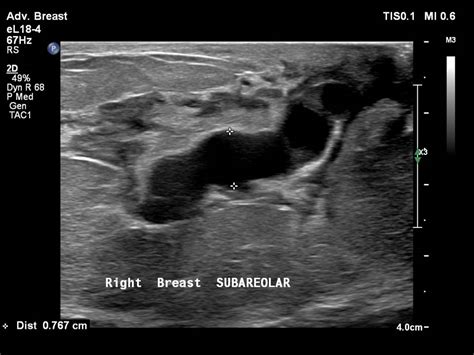 Male Breast Duct Ectasia At Patricia Witcher Blog