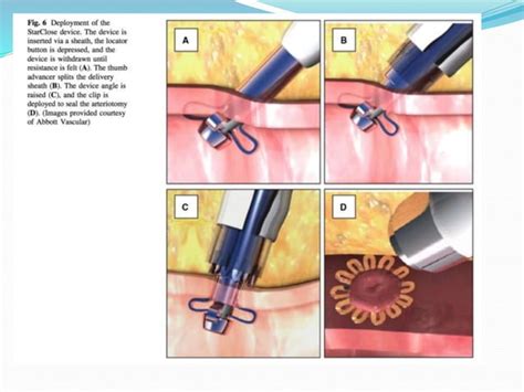 Vascular Closure Devices Pptx First Aid Injuries