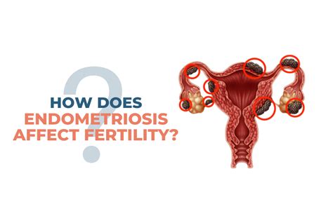 How Does Endometriosis Affect Fertility Best Gyenocologist In Jaipur