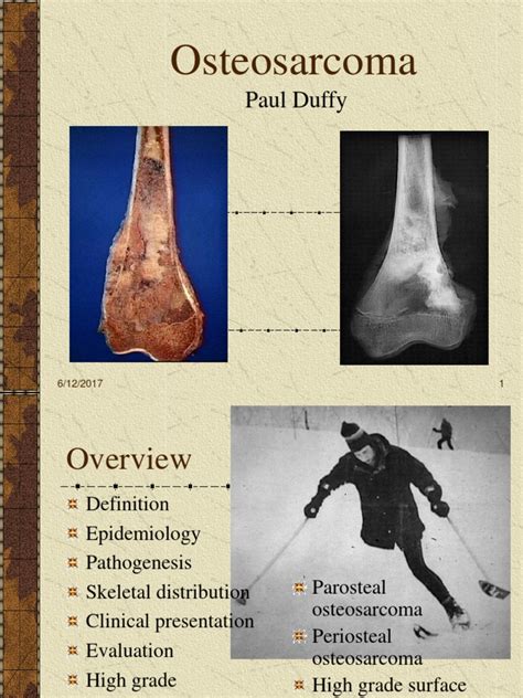 Osteosarcoma Chemotherapy Metastasis