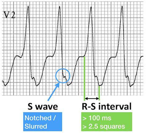 VT Versus SVT LITFL Medical Blog ECG Library Basics Sinus Tachycardia Ventricular