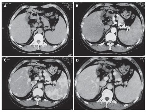 Detection Of Small Hepatocellular Carcinoma Comparison Of Dynamic