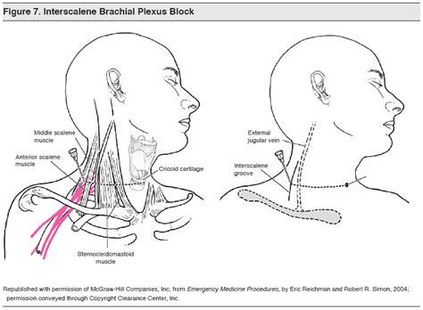 Interscalene Brachial Plexus Block