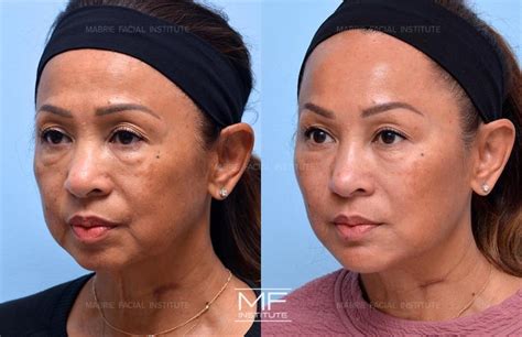 Determining How Much Botox Is Too Much Msa Best Guide