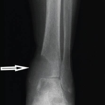 X Ray Anteroposterior Lateral View Of The Leg Showing Destruction Of Download Scientific