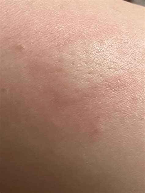 모기물린 곳 자국 지식in