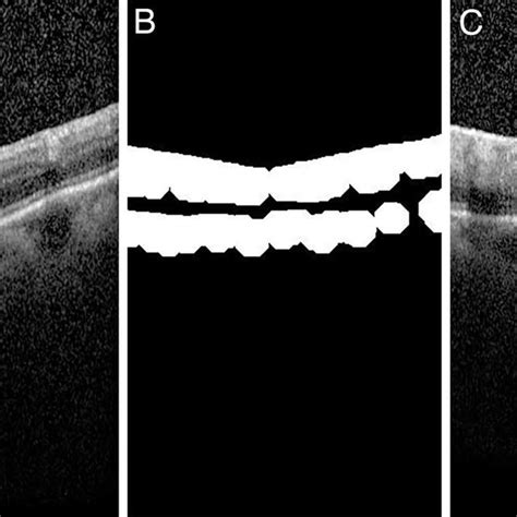 A Example Original Image B Binary Image Of Oct Scan Automatically Download Scientific