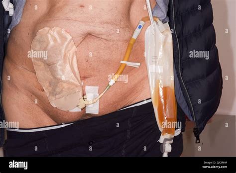 Patient With Urostomy Bag On The Abdomen Of A 68 Year Old Male Patient Following
