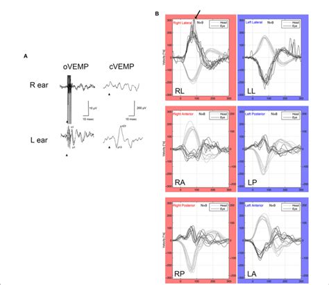 EMP And VHIT A OVEMP Hz Bone Conduction And CVEMP Hz Air Download Scientific