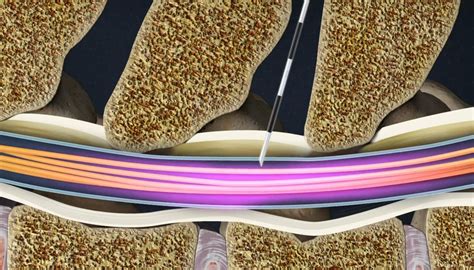 Myelography And Myelogram