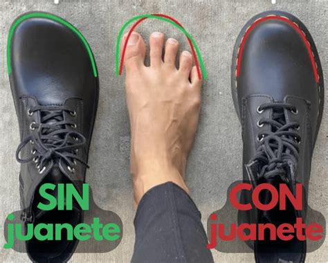 Cómo Curar Los Juanetes En Los Pies
