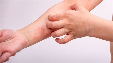 Our Eczema Rescue Cream A Clean Soothing Solution For Irritated Skin