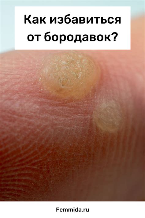 Бородавки почему появляются и как их лечить Себорейный дерматит Удаление бородавок
