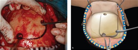 4 Midline Craniotomies Neupsy Key