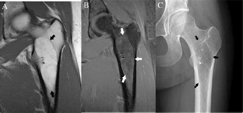 Case 1 Intraosseous Lipoma 23 Year Old Female Runner Presents With 3 Download Scientific