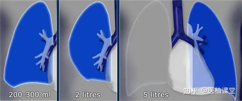 胸片的解读气胸 胸膜 胸壁 知乎