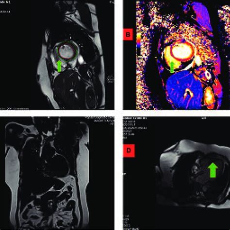 Abcd Cardiac Magnetic Resonance Imaging Showing Late Gadolinium Download Scientific