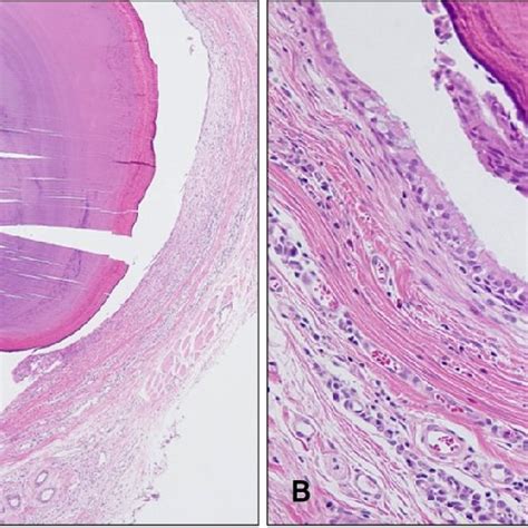 Triphasic Tertiary Contractions Of The Upper Oesophageal Body