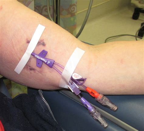 Jm S Adventure With Multiple Myeloma PICC Line Dressing Change And Labs March