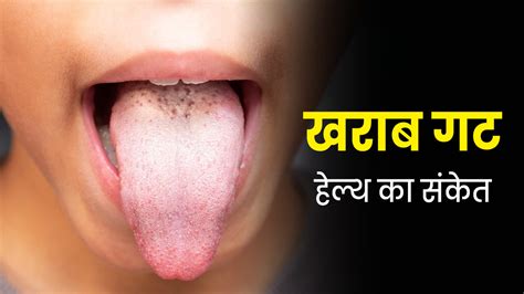 Poor Gut Symptoms जीभ पर जमी सफेद कोटिंग हो सकती है खराब गट हेल्थ का