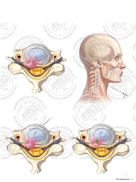 Female Left C4 5 Percutaneous Discectomy No Text