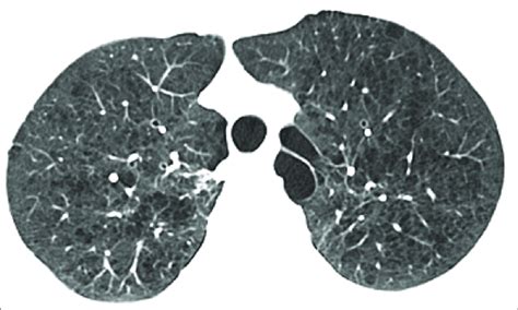 Moderate Centrilobular Emphysema Centrilobular Lucencies Involve More Download Scientific