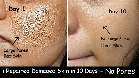 Niacinamide Serum To Close Large OPEN PORES Aloevera Ice Cubes For Skin Tightening YouTube