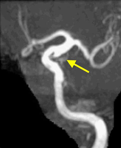 Tof Mra Artifacts Questions And Answers In Mri