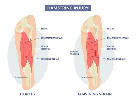Quad Vs Hamstring Strength Treating Imbalances