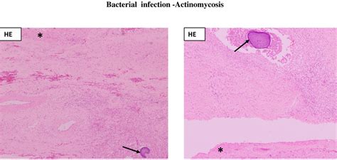 A Case Of Actinomycosis Of The Temporal Scalp Region In A Previously Download Scientific