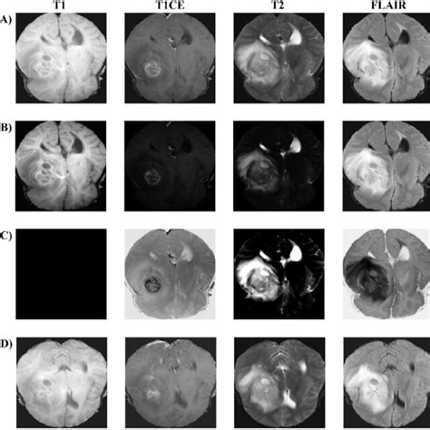 Mri Images A Before Preprocessing And After Being Implemented B