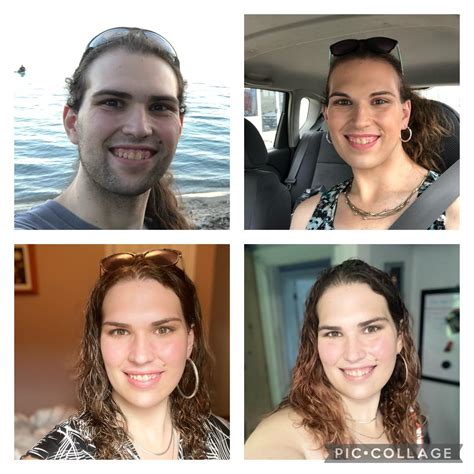 1 Year Hrt Day 1 Hrt 1 Year Hrt 2 Years Hrt 4 Months Post Op