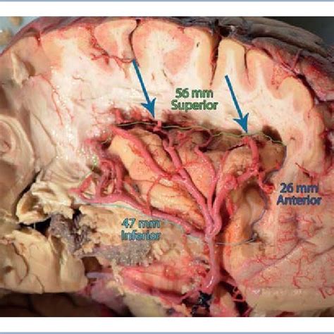 The Insula And Peri Insular Sulci Bottom And Lateral View Download