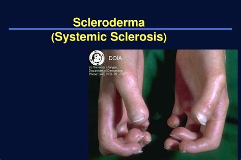 Ppt Scleroderma Systemic Sclerosis Powerpoint Presentation Free