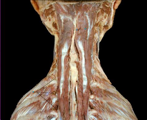 Semispinalis 1 Diagram Quizlet