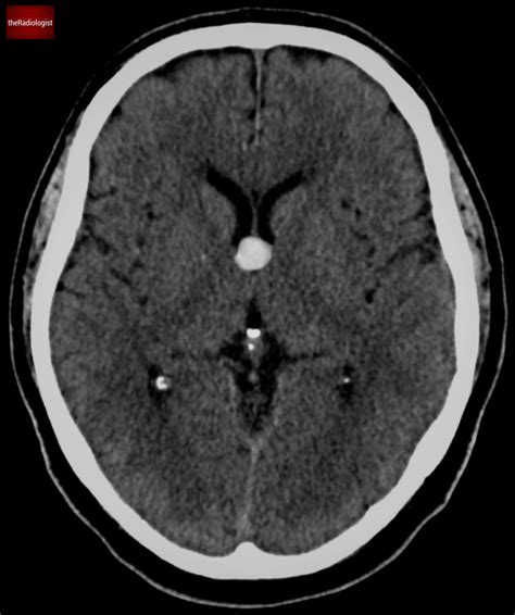 Colloid Cyst The Radiologist