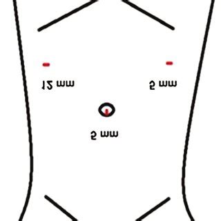 Surgical Port Position The Port Location For Emergency Laparoscopic Download Scientific