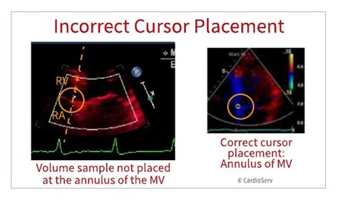 Avoid These Diastology Measurement Errors Cardioserv