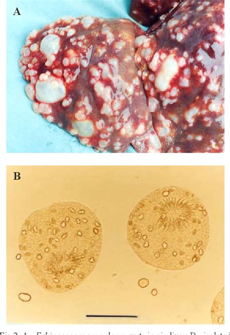Echinococcus Multilocularis Cyst