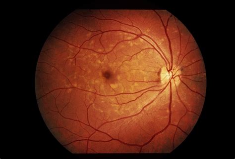 Reticular Pattern Dystrophy Retina Image Bank