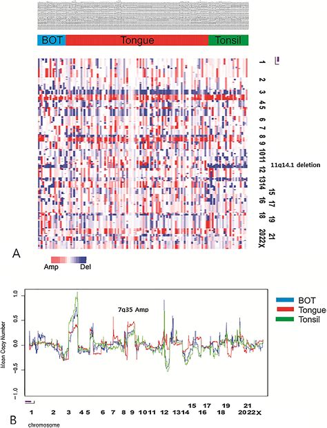 Lingual Tonsil Cancer Symptoms