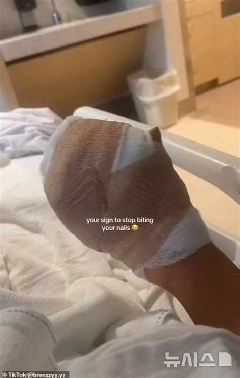 손톱 물어뜯지 마세요수술까지 받은 여성의 경고