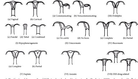 Mullerian Agenesis Classification Mullerian Anomalies Dr T Ramani
