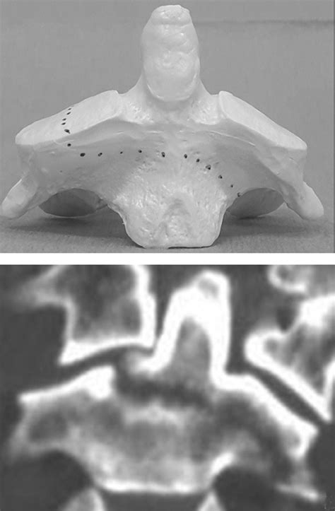 Transverse Type C2 Vertebral Body Fracture Depicted On An Anatomical