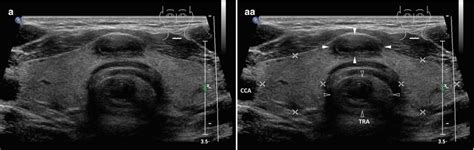 Fig 22 Simple Diffuse Goiter A Transverse Ultrasound