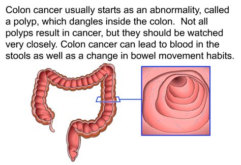 Colonoscopy African American Outreach
