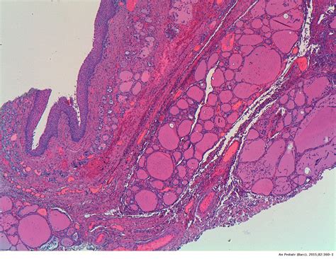 Thyroglossal Duct Cyst Cytology