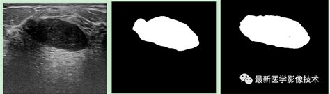 Kaggle挑战赛——超声乳腺癌分割 腾讯云开发者社区 腾讯云