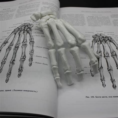 Hand Bone Dislocation 4 And 5 Metacarpal Joint・free 3d File For ・cults